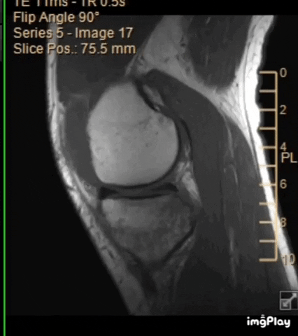 Journey through the center of my stupid knee. : InterestingGifs